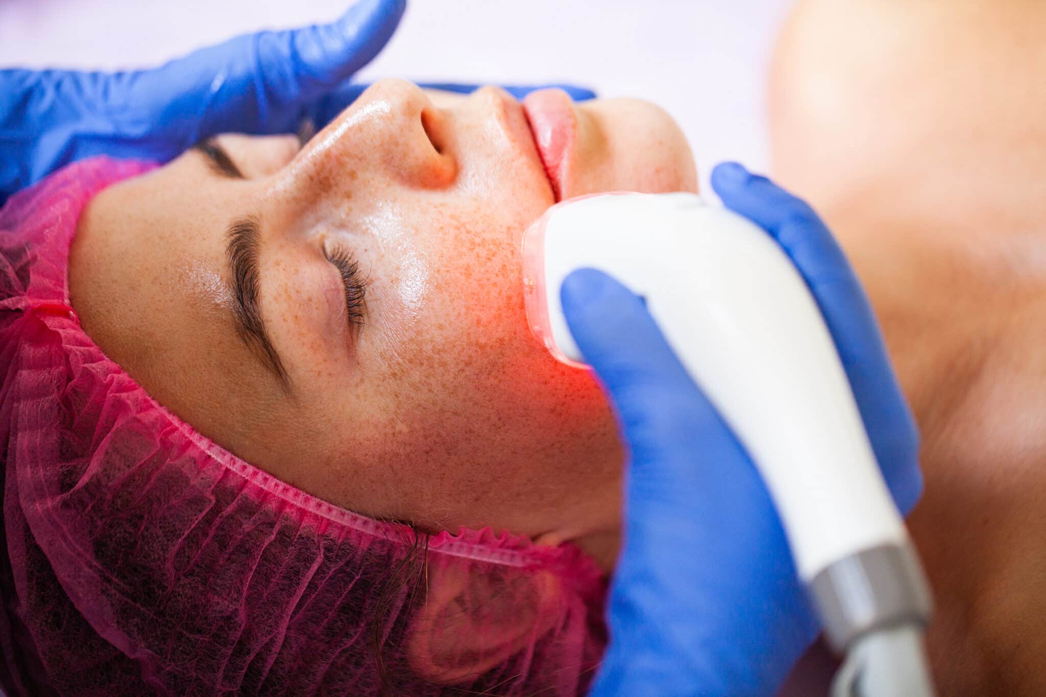 Laser Treatment for Acne Scars - Nita Patel, MD